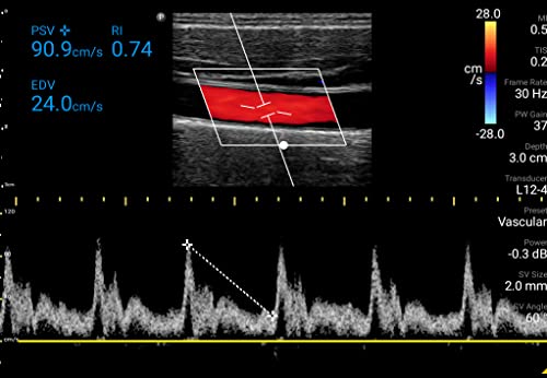 Philips FUS6882 Lumify L12-4 Linear Array Transducer, Portable Ultrasound Solution