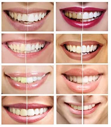 White Teeth Global 10 Syringes (3ml) New Strongest 44% Carbamide Peroxide Teeth whitening Gel