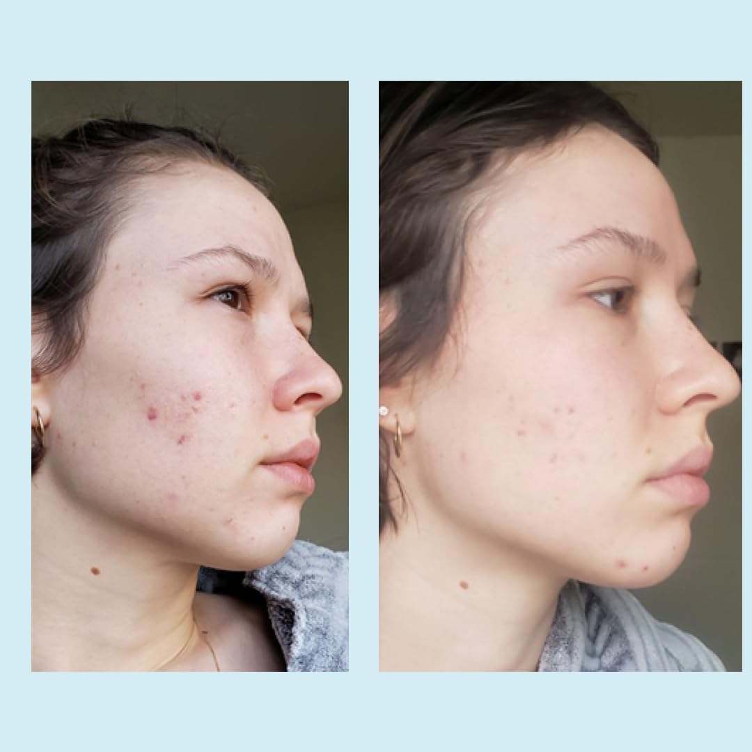 Glycolic Acid 50% Gel Peel - Enhanced with Retinol & Green Tea Extract (Professional Skin Peel)1 ounce