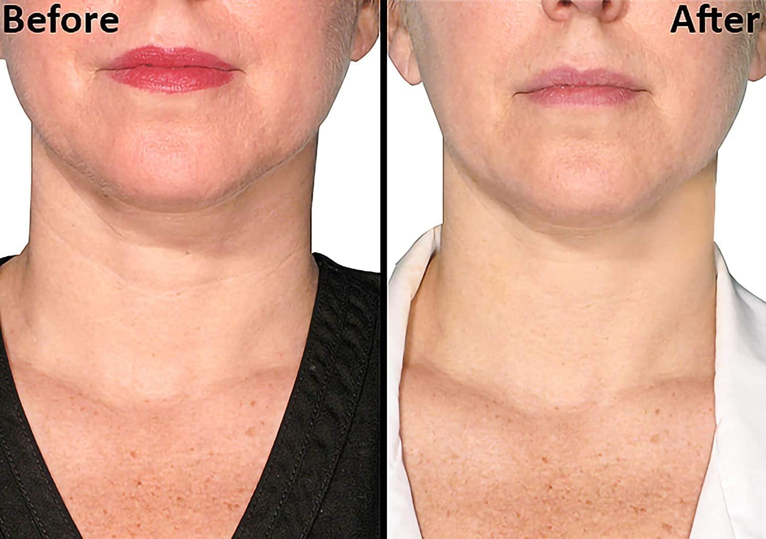 PHCOMRICH Neck wrinkle patches x 2,Anti-aging Advanced skin firming Treatment and Prevention - silicone wrinkle patches reusable (16 day supply).