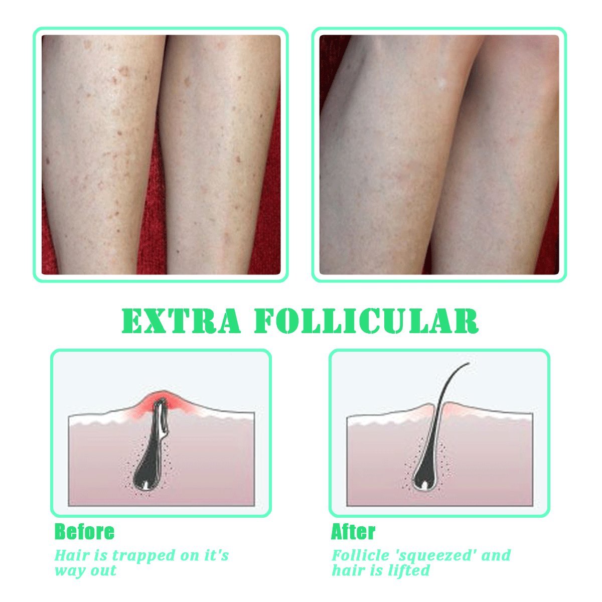 TailaiMei Exfoliating Brush for Ingrown Hair Treatment - To Treat and Prevent Bikini Bumps, Razor Bumps - Silky Smooth Skin Solution for Men and Women