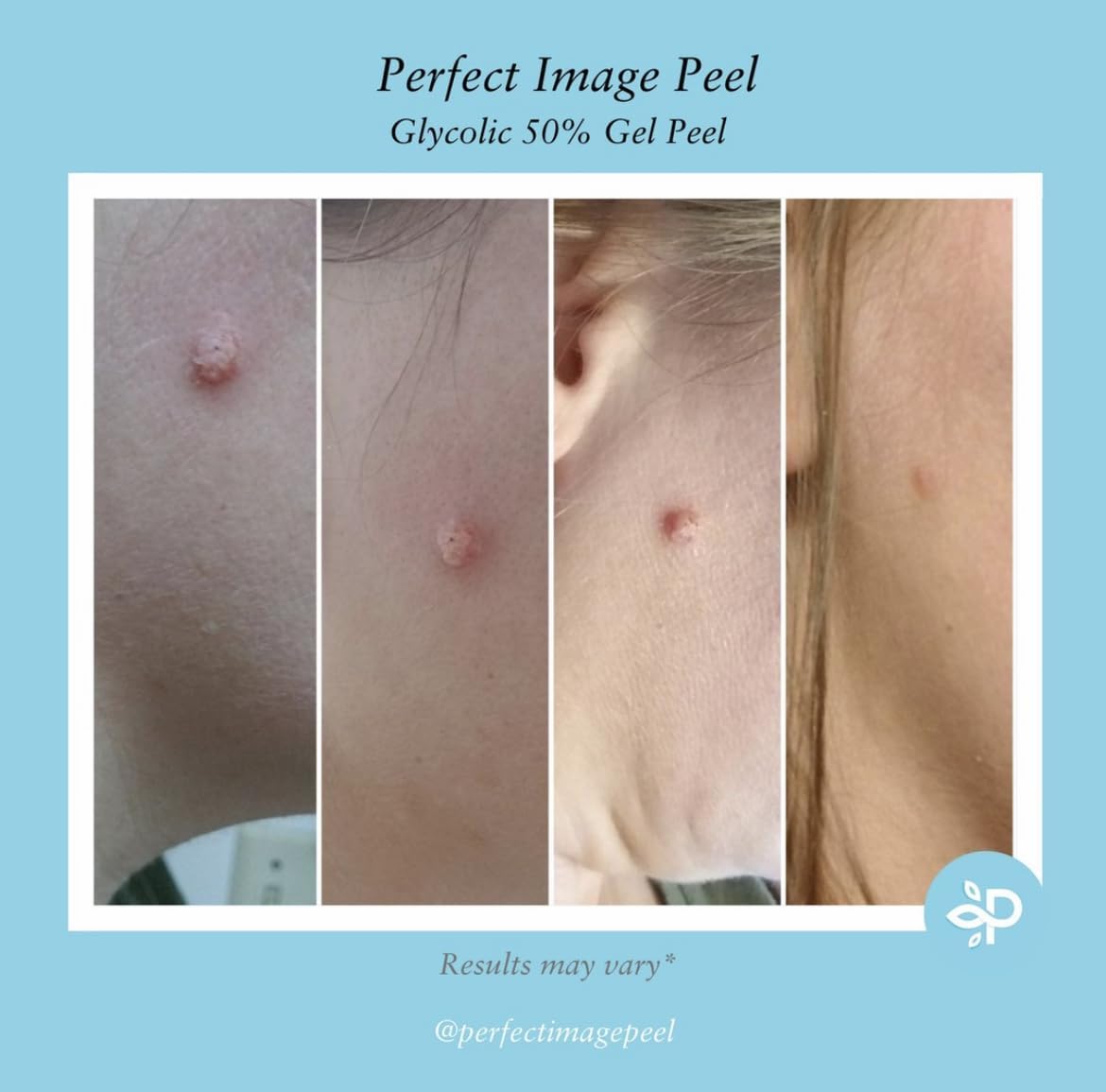 Glycolic Acid 50% Gel Peel - Enhanced with Retinol & Green Tea Extract (Professional Skin Peel)1 ounce