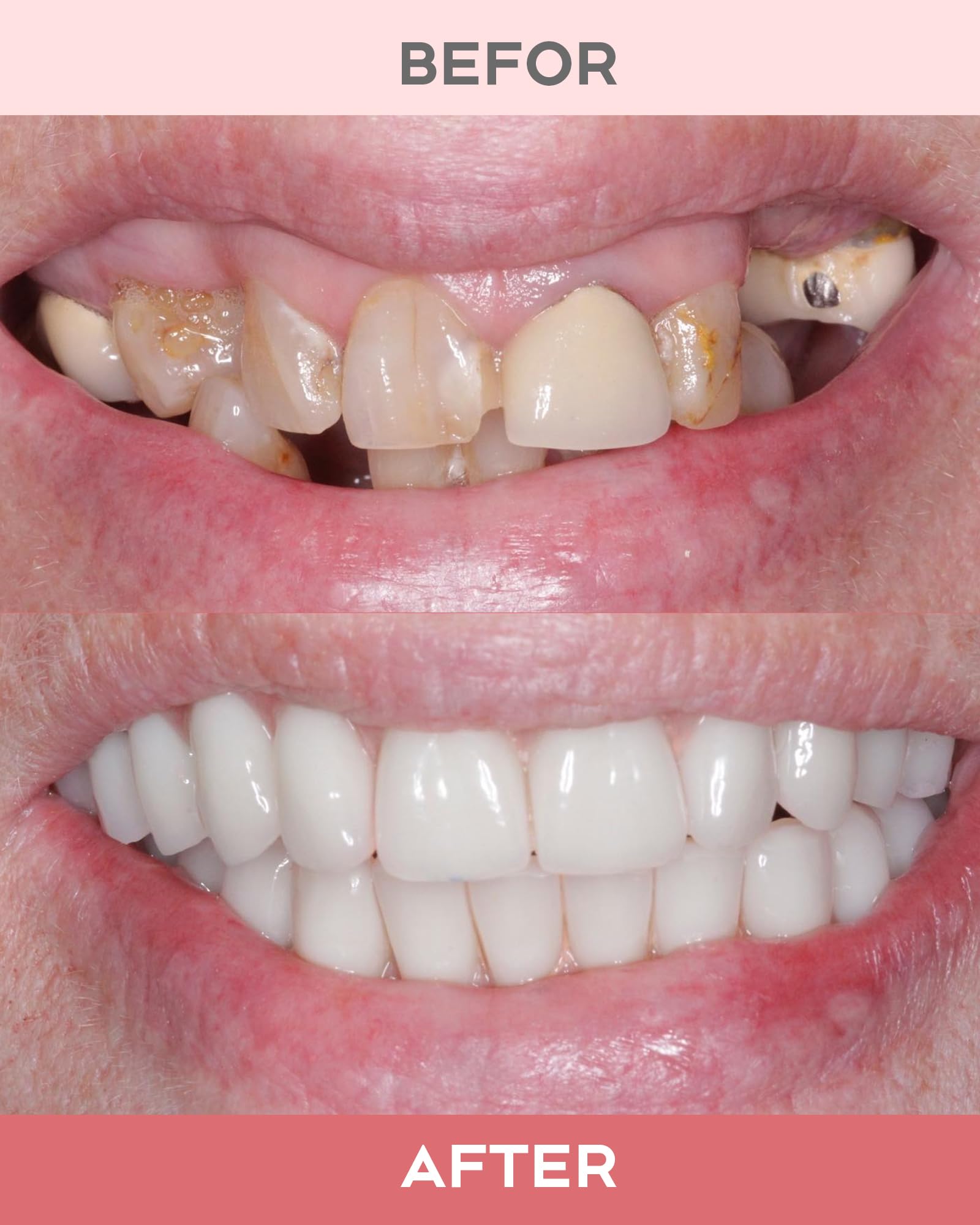 AEE Dentures Do it Yourself Full Set of Top and Bottom Fake Teeth, for Improve Smile, DIY Denture Kit Easy and Convenient, Fake Teeth Repair Missing Teeth, False Teeth for Protect Your Teeth