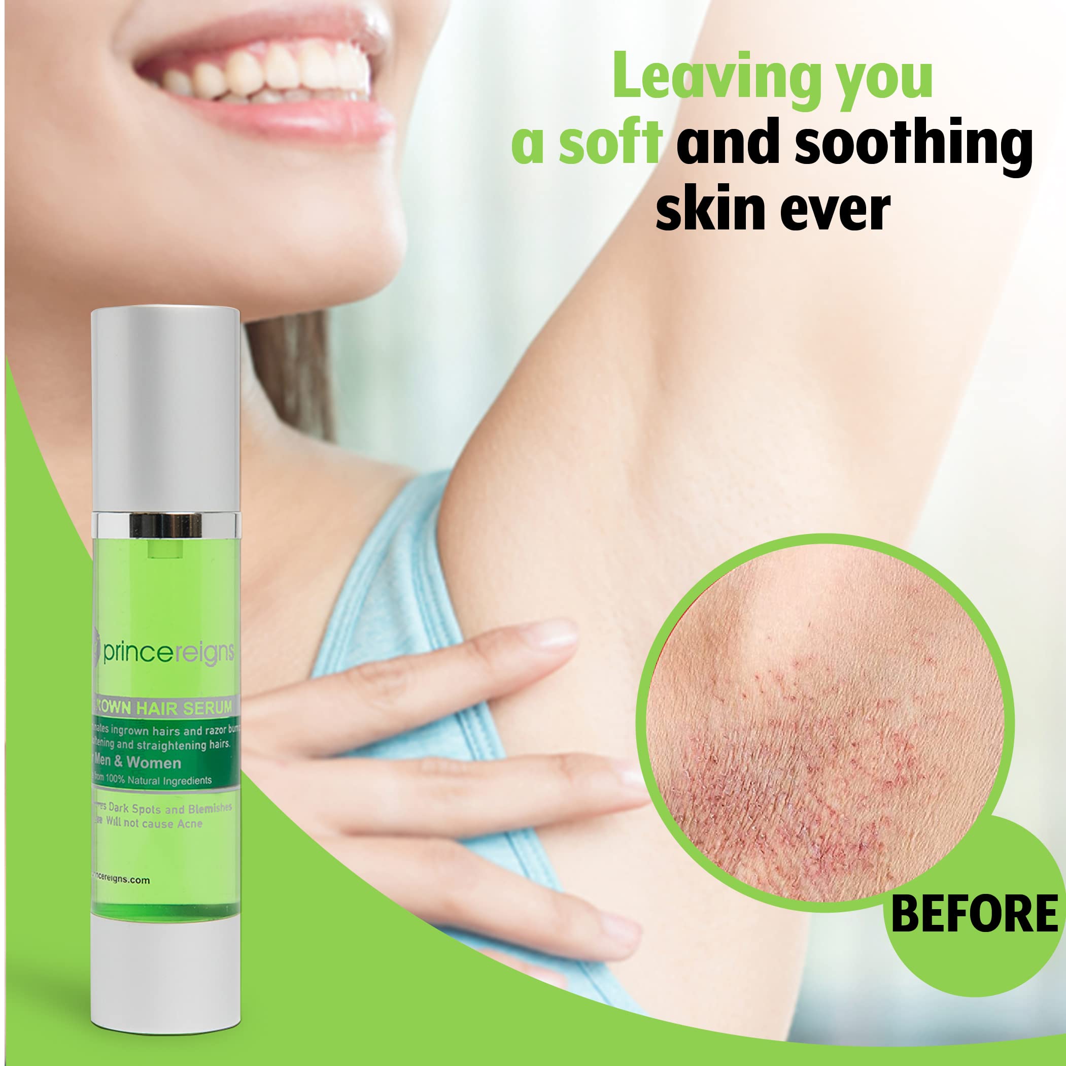 Princereigns Ingrown Hair Serum - Organic Razor Bump & Redness Solution for Men & Women, Ideal for Face, Bikini, Legs, Underarm, Prevents Future Ingrown Hairs, No Alcohol or Oils - 2 Fl. Oz