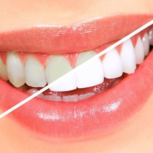 Expertwhite 16% Carbamide Teeth Whitening Gel Made in The USA for Sensitive Teeth (4 gels, 3cc Each). The Best Carbamide Peroxide for Bright White Teeth is Used with Any Teeth whitening Trays.