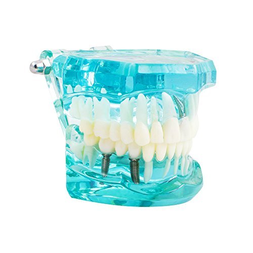 vinmax Dental Teeth Model,Transparent Dental Implant Disease Teeth Model Dentist Standard Pathological Removable Tooth Teaching Tools for Student (Pathological Teeth Model)