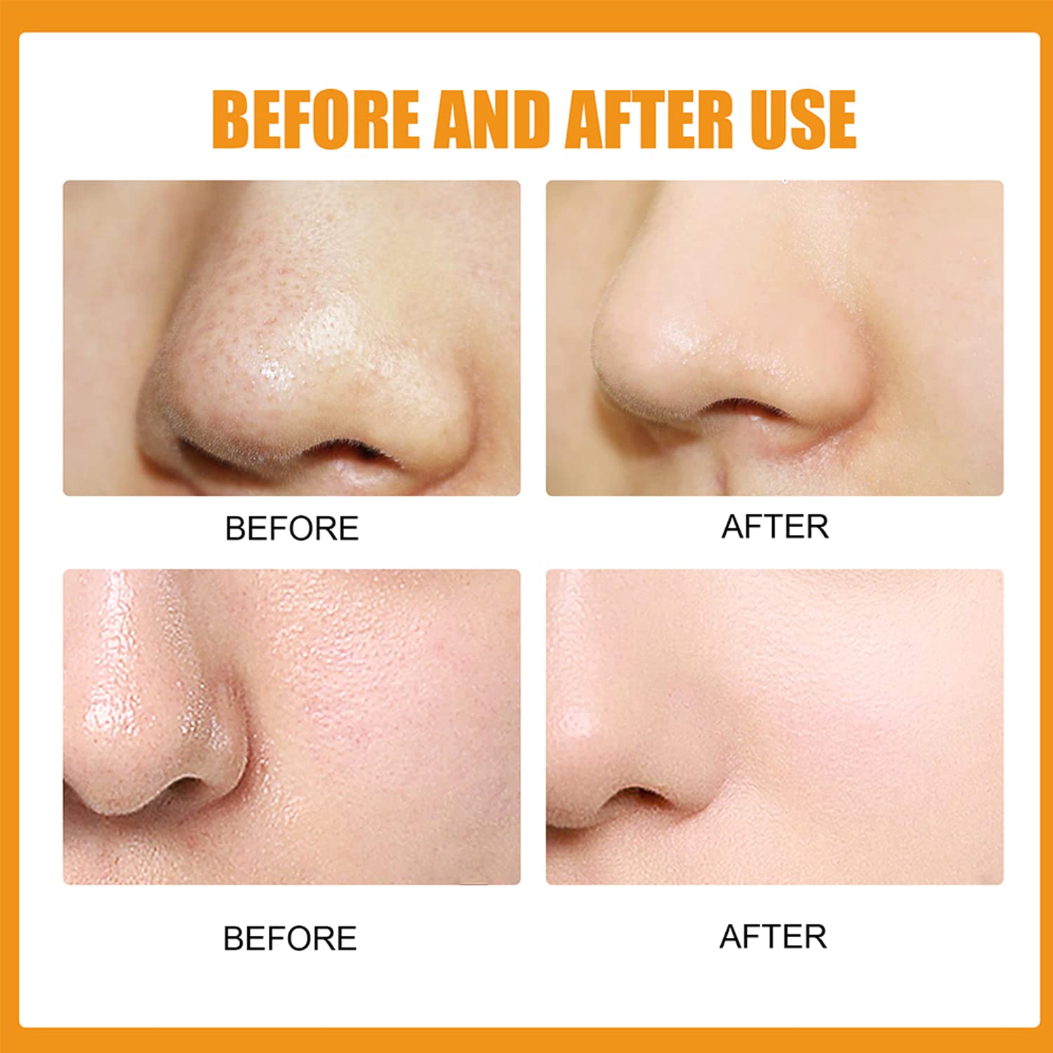 Blackhead Remover 16pcs Kit with Portable Box
