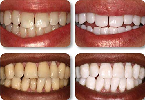 Ultra White 22% Teeth Whitening Gel Large 5 Tubes 3.8 ml of Gel use for Beautiful White Smile