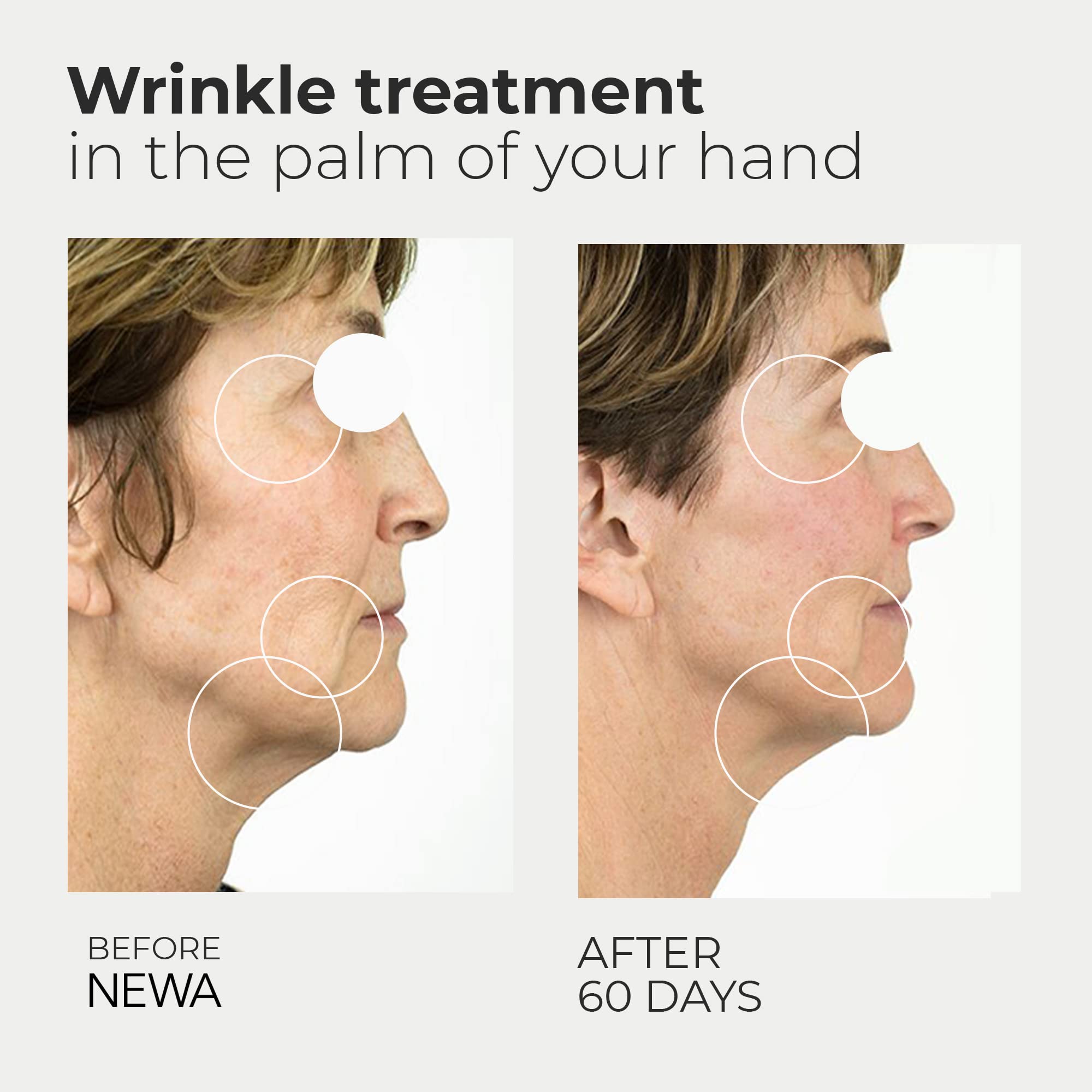 NEWA RF Wrinkle Reduction Device (Plug in) - FDA Cleared Skincare Tool for Facial Tightening. Boosts Collagen, Reduces Wrinkles. with 1 Month Gel Supply.