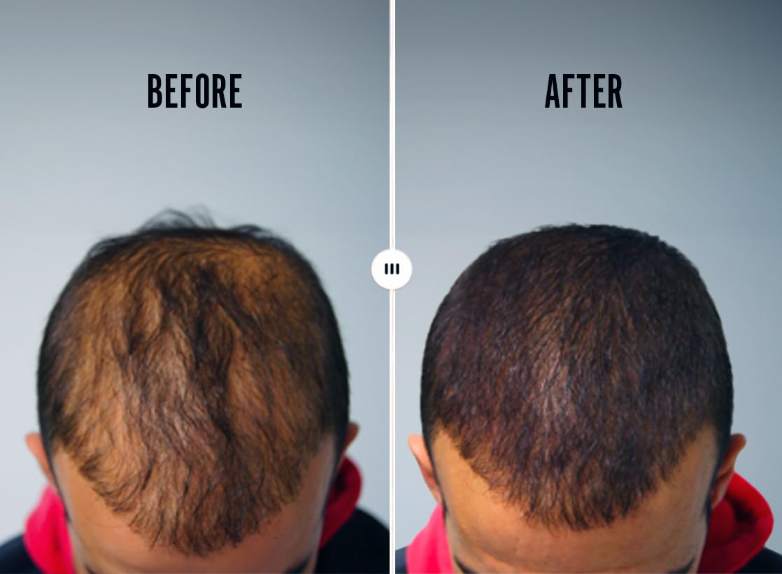 Revivogen MD Scalp Therapy Thinning Hair Solution and Bio-Cleansing Shampoo Set