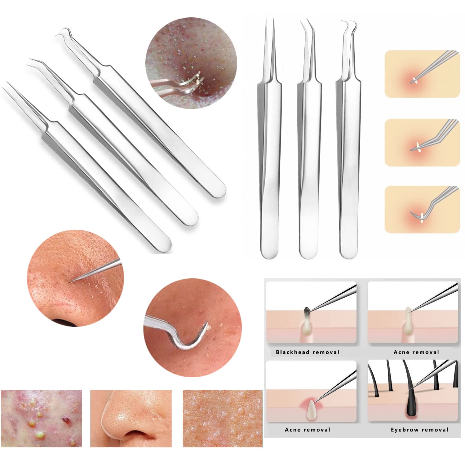 Blackhead Remover 16pcs Kit with Portable Box