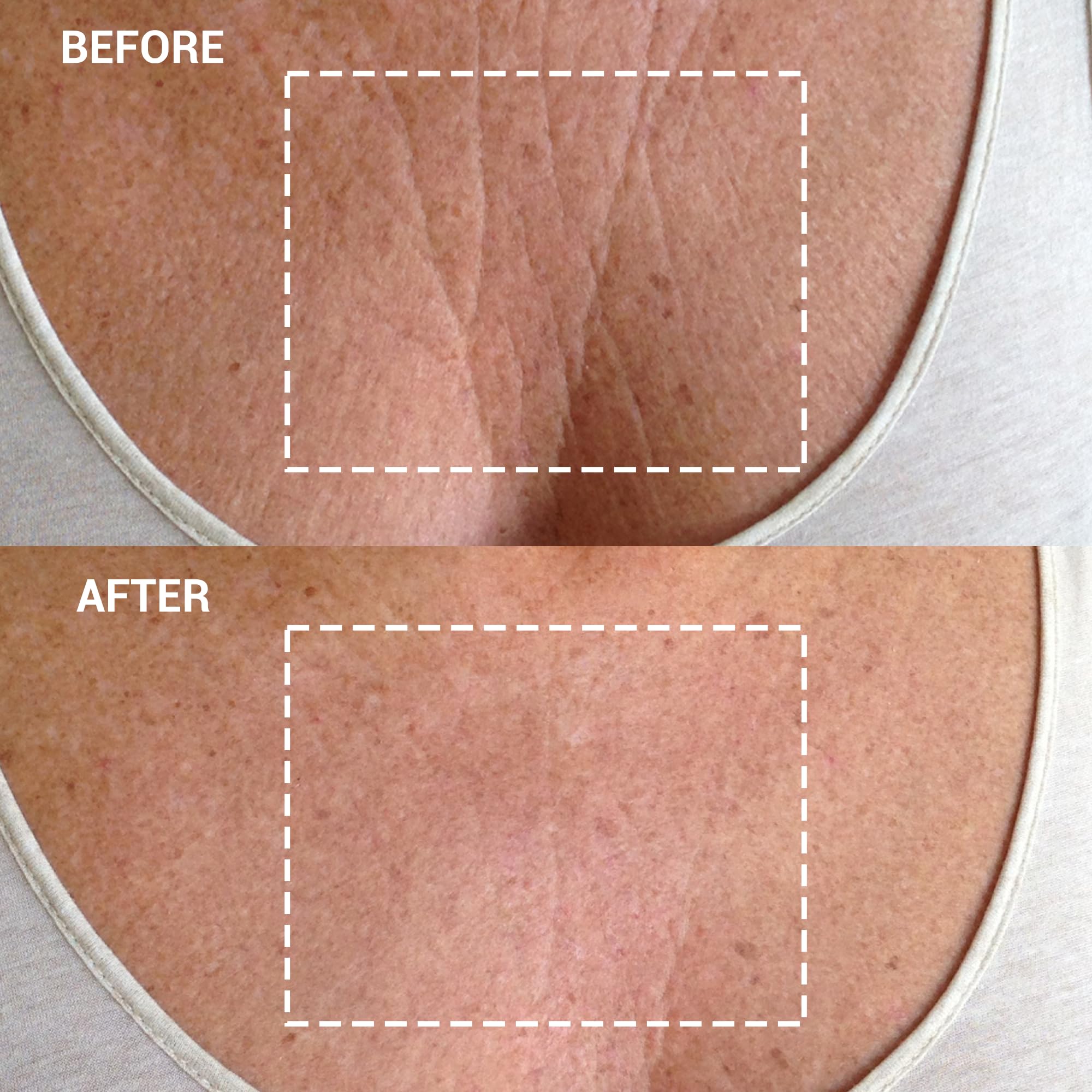 Wrinkles Schminkles Chest Wrinkle Patch - Reusable Silicone Smoothing Pads for Cleavage & Body, Reduce Wrinkles & Stretch Marks, Sensitive Formulated, Secret to Radiant Skin (1 Pack)