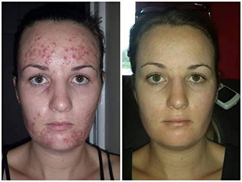 Instanly Ageless - Anti Wrinkle 5 Vials (.6mL Each)
