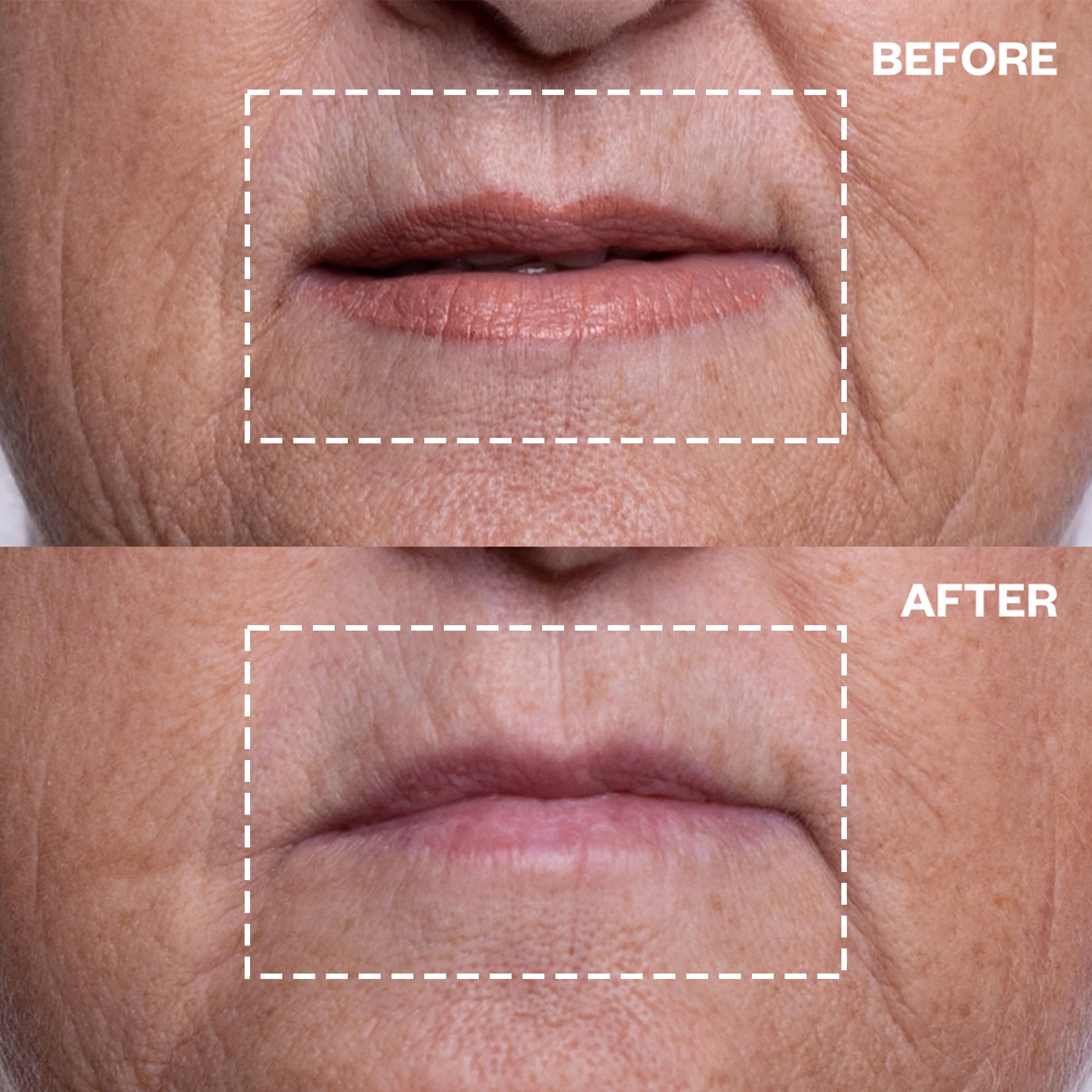 Wrinkles Schminkles Mouth & Lip Wrinkle Patch - Reusable Silicone Smoothing Pads for Noticeable Wrinkle Reduction - Lip Wrinkle Prevention for Youthful, Smooth Skin (2 Pack)