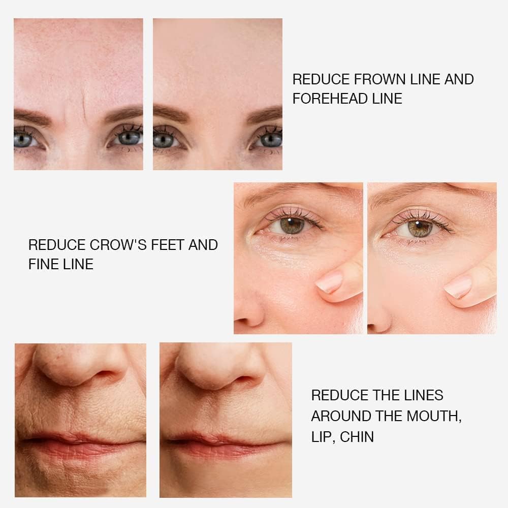 Radio Frequency Machine Professional 25 Watts Face RF Increase Collagen Firm Skin Wrinkle Reducing
