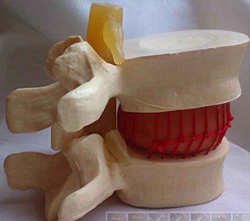 New 2pcs Anatomical Human Lumbar Vertebrae Degenerative Lumbar disc herniation demonstration model Human spine Sold by East Dental