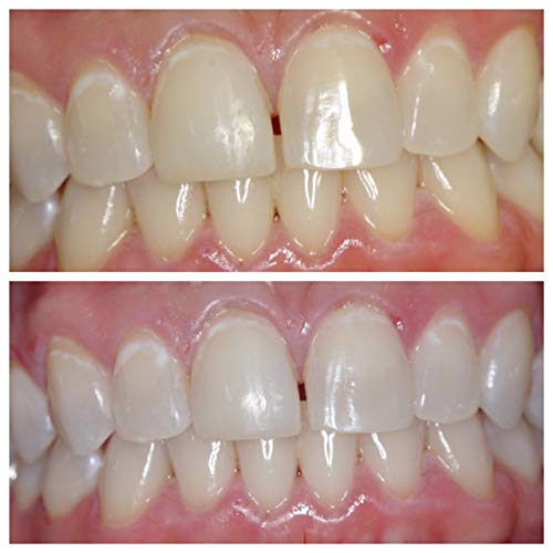 Ultra White 22% Teeth Whitening Gel Large 5 Tubes 3.8 ml of Gel use for Beautiful White Smile
