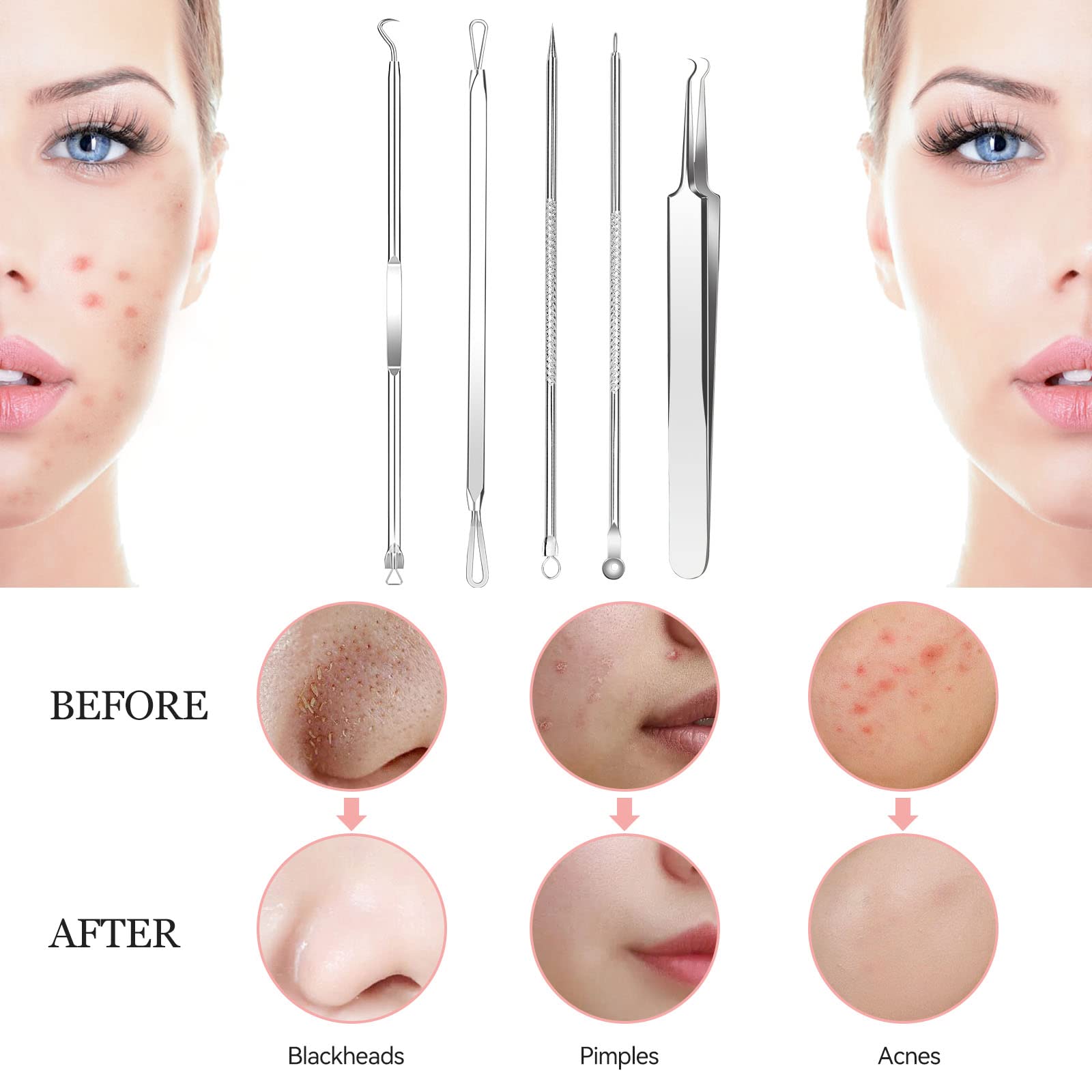 Blackhead Remover Tool Stainless Steel Comedone Pimple Extractor Kit with Portable Metal Case for Comedone Zit Acne Whitehead Blemish