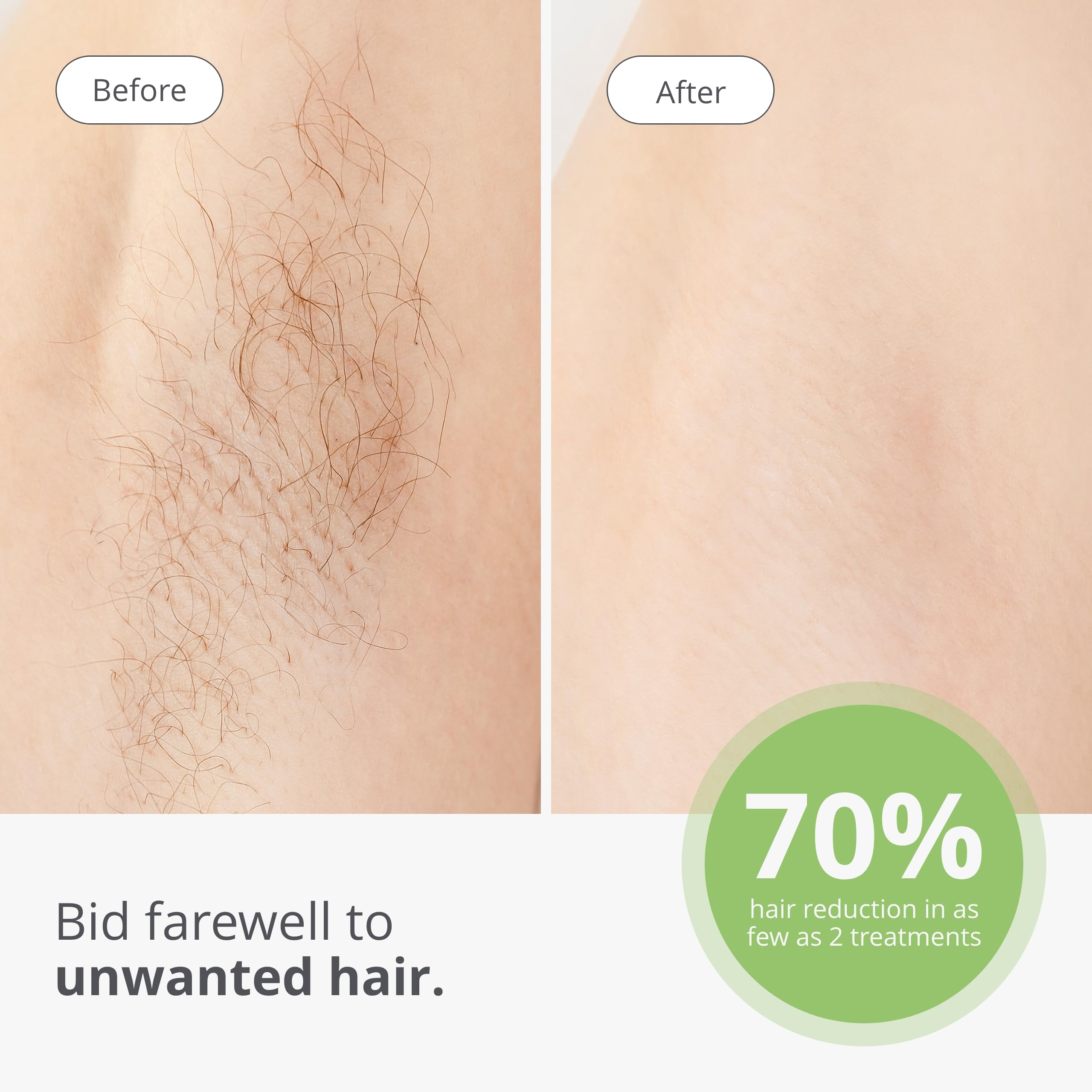Tria Hair Removal Laser 4X - Safe At-Home Laser Hair Removal for Women and Men - Green