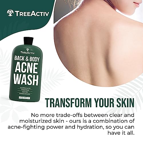 TreeActiv Acne Exfoliating Body Wash, 8oz, Foam Cleanser for All Skin Types, Sulfur, Aloe Vera, Jojoba Beads
