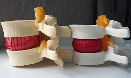 New 2pcs Anatomical Human Lumbar Vertebrae Degenerative Lumbar disc herniation demonstration model Human spine Sold by East Dental