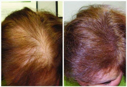Miracle Plus Thick Hair Shampoo for Thinning Hair for Men and Women 8oz.