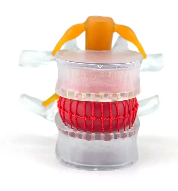 DenFactory Human 1.5 Times Life-Size Transparent Lumbar Disc Herniation Spine Model for Teaching and Learning