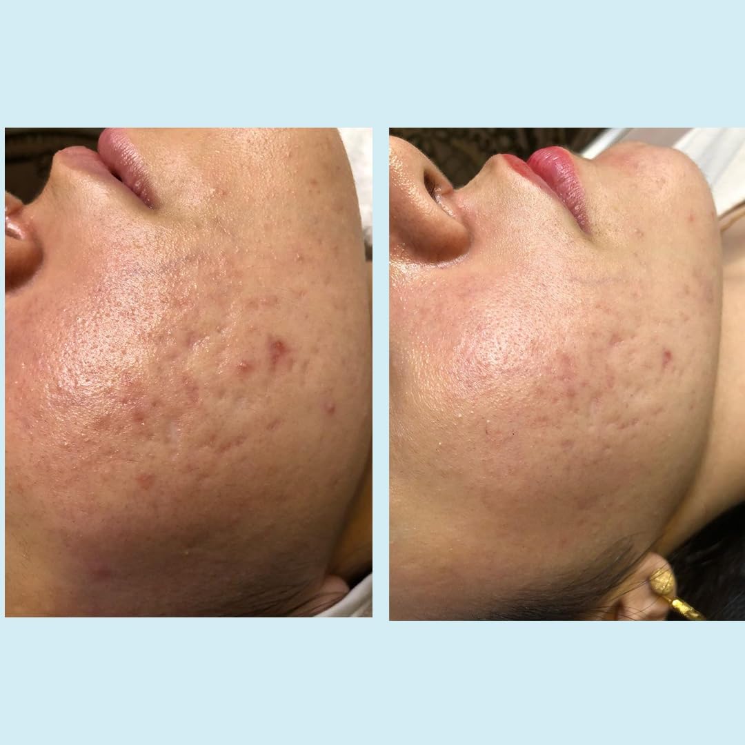 Salicylic Gel Chemical Peel - Enhanced with Green Tea Extract and Tea Tree Oil (20% Strength)