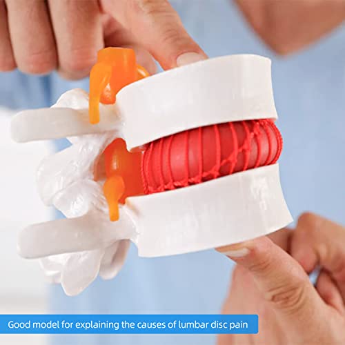 faruijie Disc Herniation Model - 1.5X Lumbar Herniated Disc Model Vertebral Spine Anatomical Medical Model
