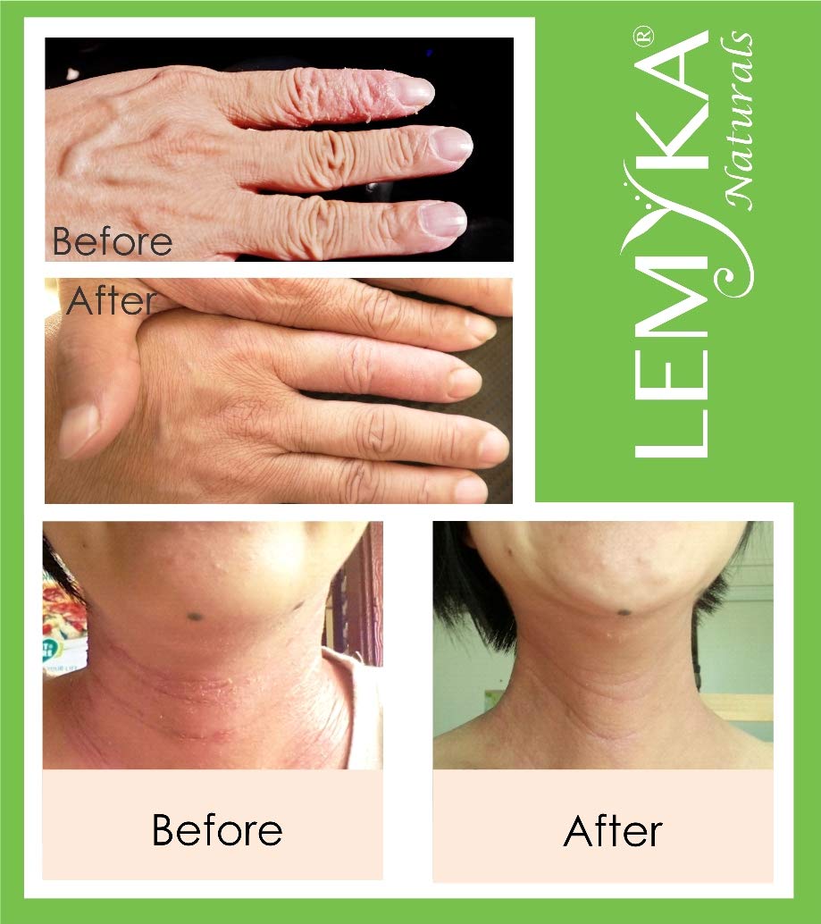 LEMYKA Eczema Flare Defense Natural Calming Cream - 3 Pack Bundle, for Infants, babies, kids, and adults with Eczema (Atopic Dermatitis), Dry Itchy Patches, Skin Rashes, Steroid Free