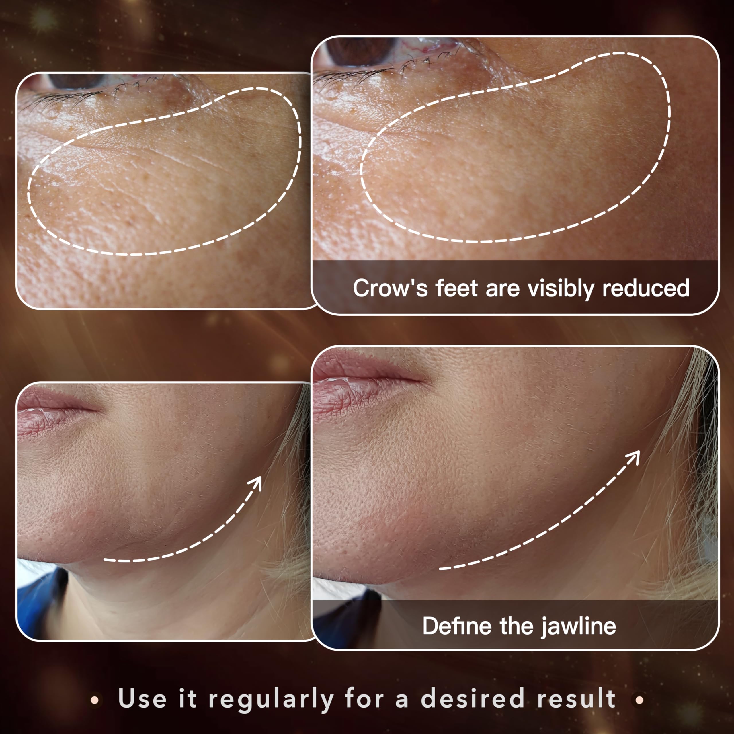 Radio Frequency Machine Professional 25 Watts Face RF Increase Collagen Firm Skin Wrinkle Reducing