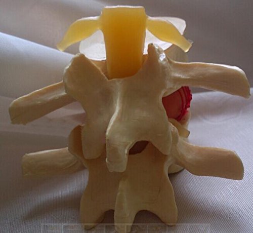 New 2pcs Anatomical Human Lumbar Vertebrae Degenerative Lumbar disc herniation demonstration model Human spine Sold by East Dental