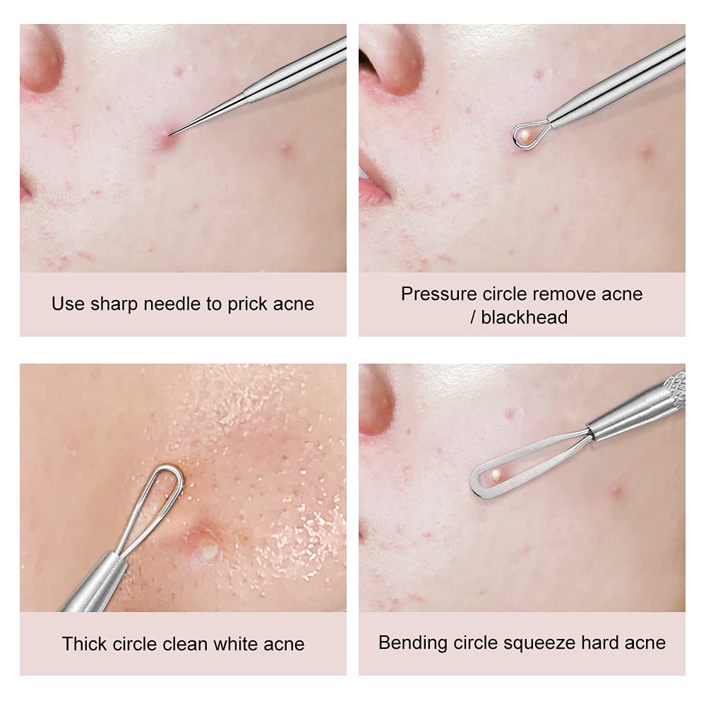 Blackhead Remover, 2 PCS Pimple Popper ,Stainless Steel Pimple Extractor Blackhead Removal Tool Risk Free Treatment for Blemish,Whitehead Popping