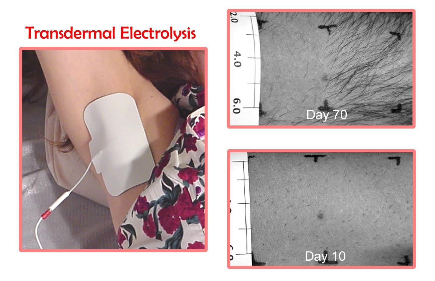 AVX400 Salon Quality Permanent Hair Removal Transdermal Electrolysis System
