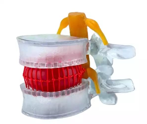 DenFactory Human 1.5 Times Life-Size Transparent Lumbar Disc Herniation Spine Model for Teaching and Learning