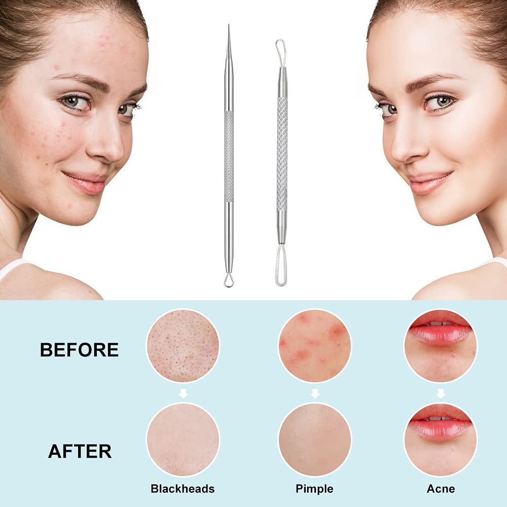 Blackhead Remover, 2 PCS Pimple Popper ,Stainless Steel Pimple Extractor Blackhead Removal Tool Risk Free Treatment for Blemish,Whitehead Popping