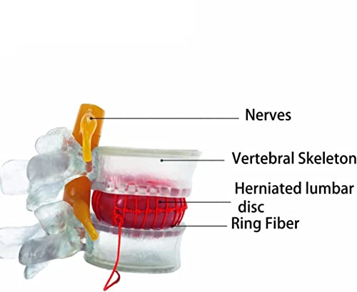 DenFactory Human 1.5 Times Life-Size Transparent Lumbar Disc Herniation Spine Model for Teaching and Learning