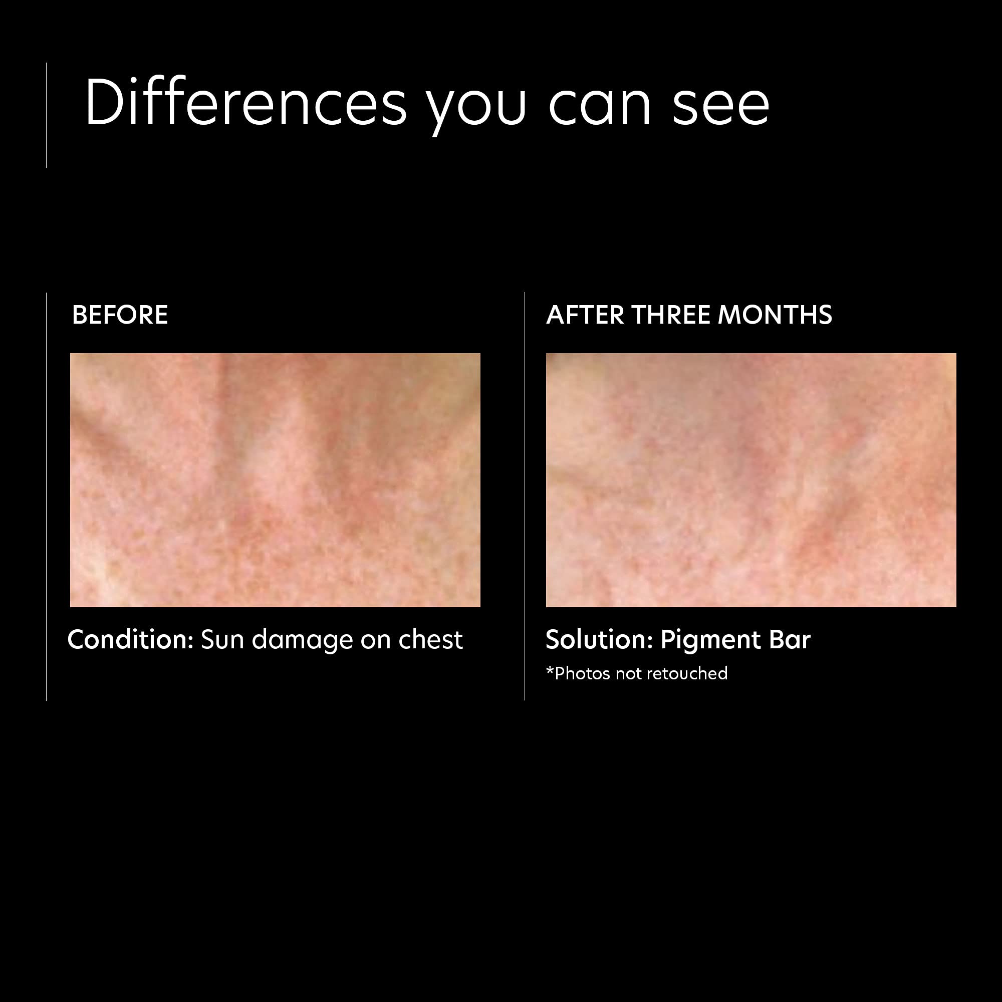PCA SKIN Pigment Bar, Hyperpigmentation Soap for Dark Spots, Formulated with Azelaic Acid and Kojic Acid, 3.2 fl oz Jar