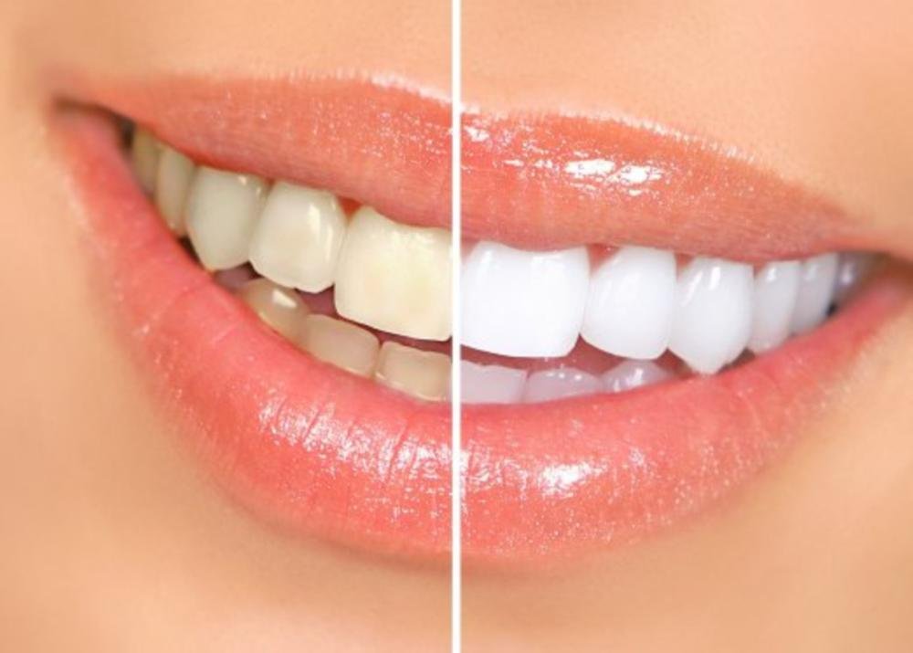 Smilebriter Teeth Whitening Gel Pens, 2 Pens :: No Peg, PPG, Artificial Flavors, or GMOs :: Gentle on Sensitive Teeth, Organic Ingredients :: Supports Dental Health, Mint Flavor