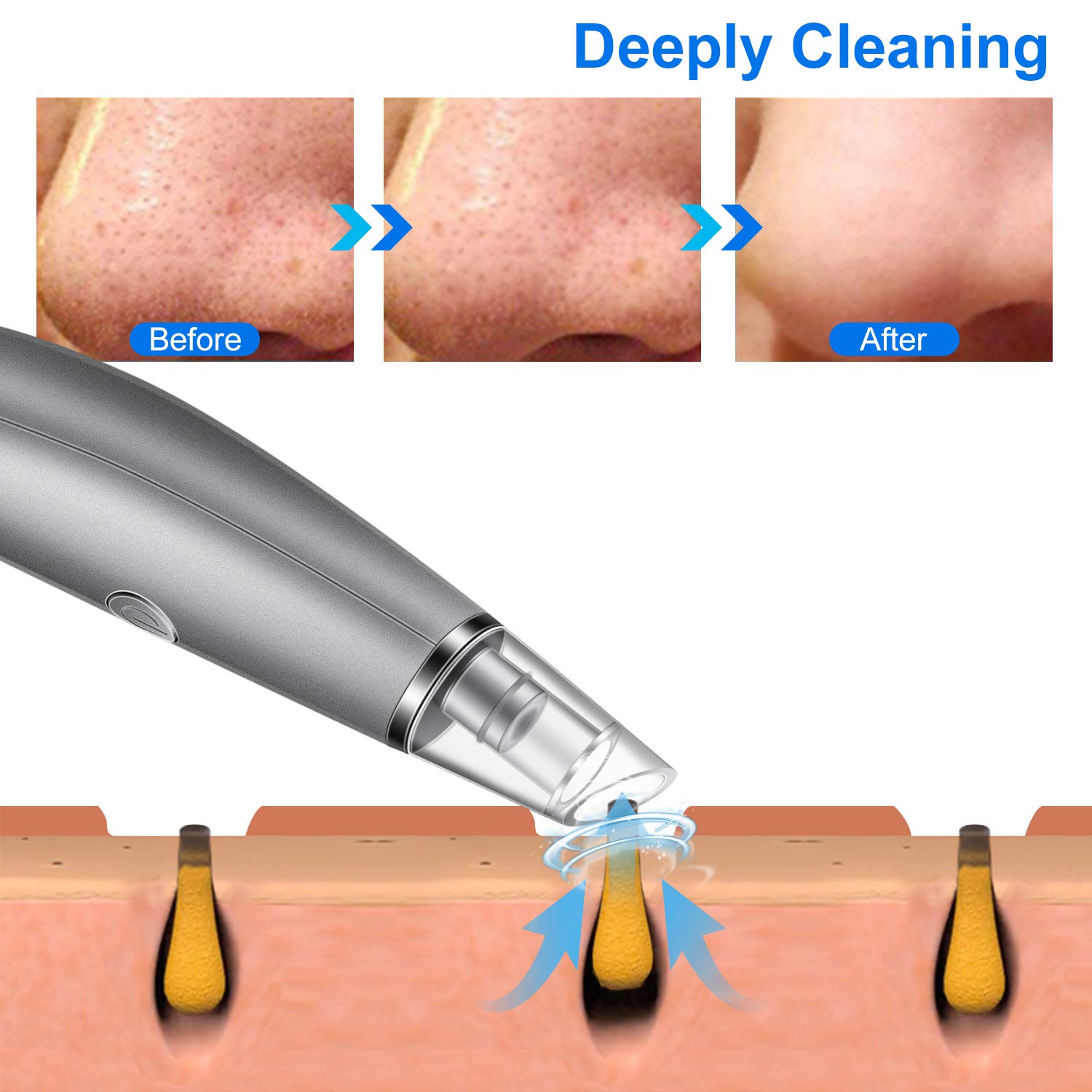 Blackhead Remover Vacuum Pore Cleaner, Alin&Alan Electric Blackhead Vacuum Suction Devices, USB Rechargeable Acne Comedone Extractor Tool Kit (Grey)