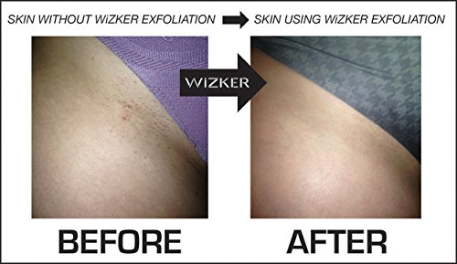WIZKER Exfoliating Brush: Ingrown Hair Prevention, Razor Bump Treatment | Original Extra-Strength Bristle Exfoliator for Face, Body, Leg, Bikini | Shaving and Waxing Solution | Bath Shower Waterproof