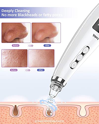 Blackhead Remover Pore Vacuum - Upgraded Strong Suction Electric Pore Cleanser Beauty Device for Deep Facial Skin Cleaning - 5 Adjustable Suction, 6 Different Replacement Probes, USB Rechargeable