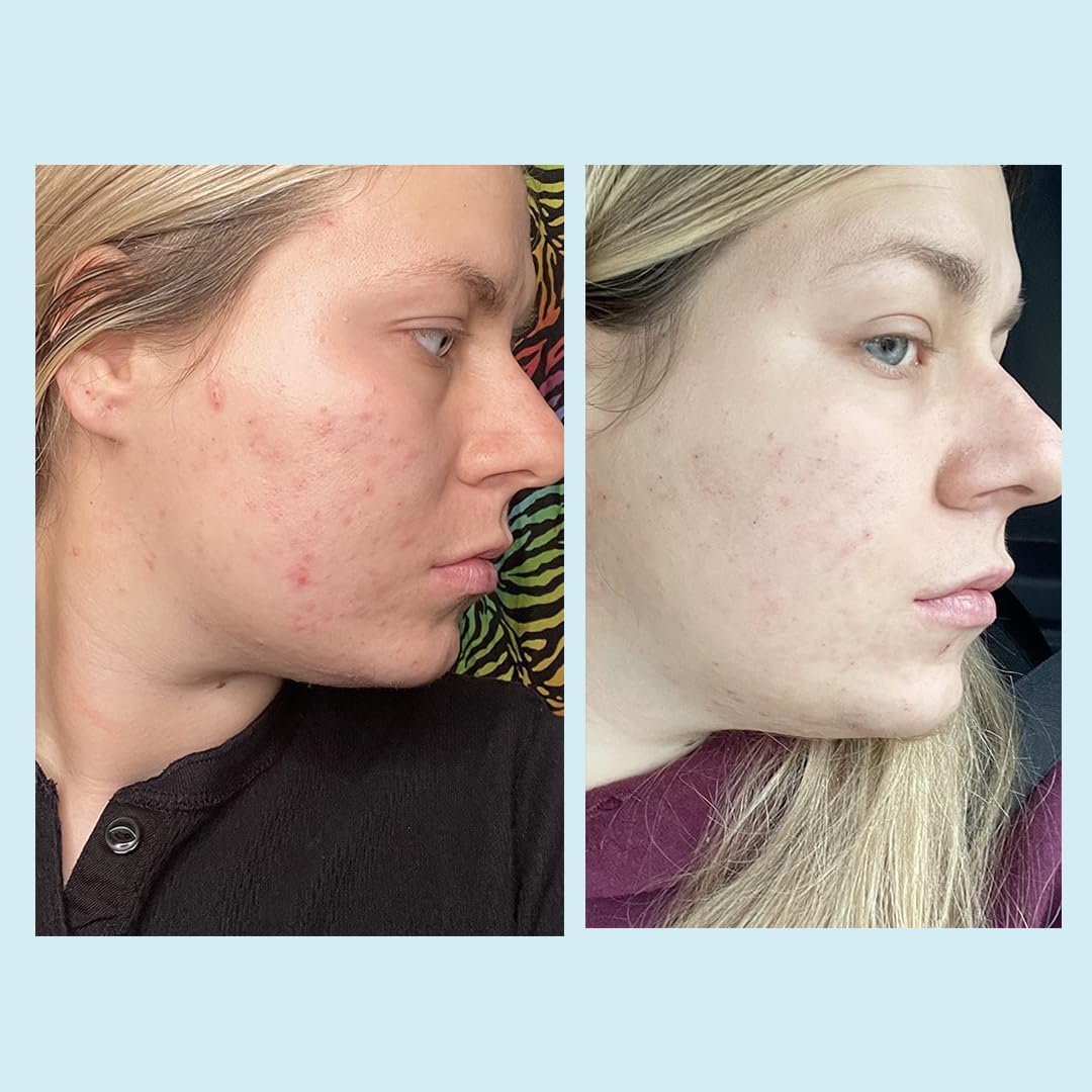 Salicylic Gel Chemical Peel - Enhanced with Green Tea Extract and Tea Tree Oil (20% Strength)