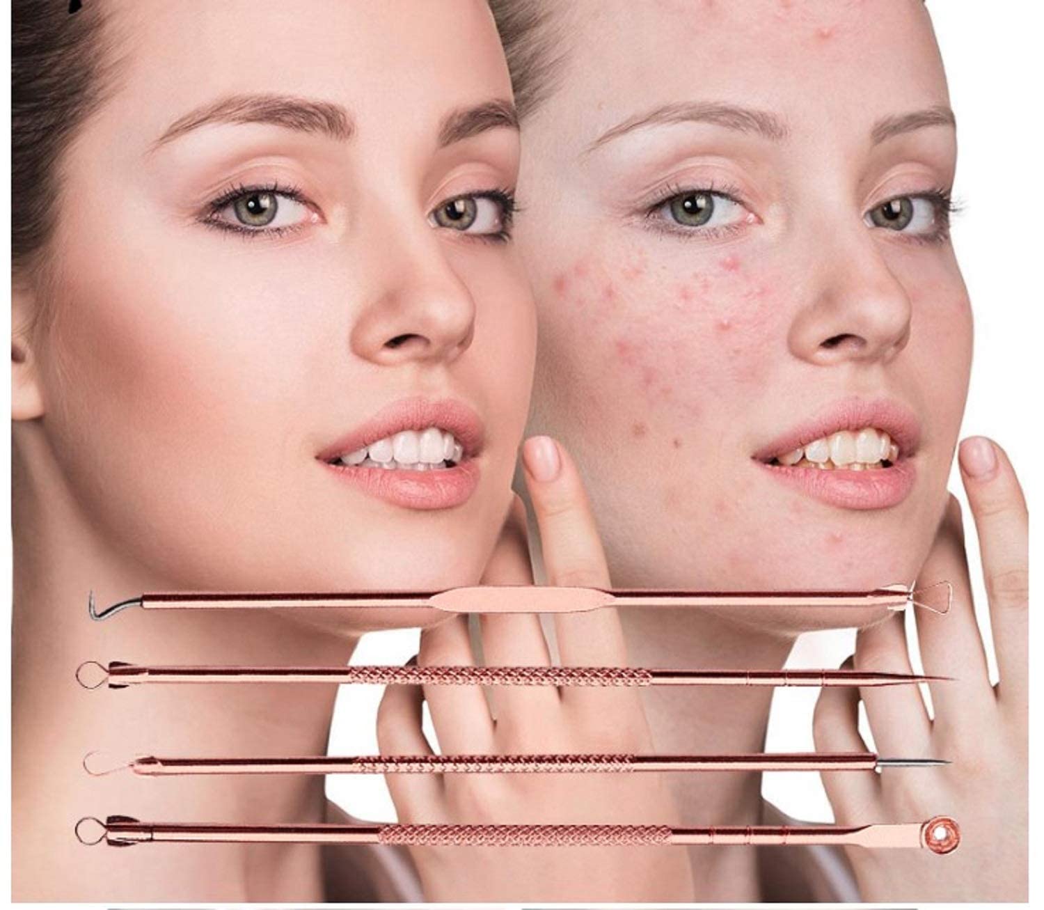 Blackhead Remover Pimple Comedone Extractor Tool, Effective Acne Removal Kit, Treatment for Blemish, Whitehead Pimple Popping, Zit Removing for Nose & Face Skin, Best Electroplated 4 PCS w/case.