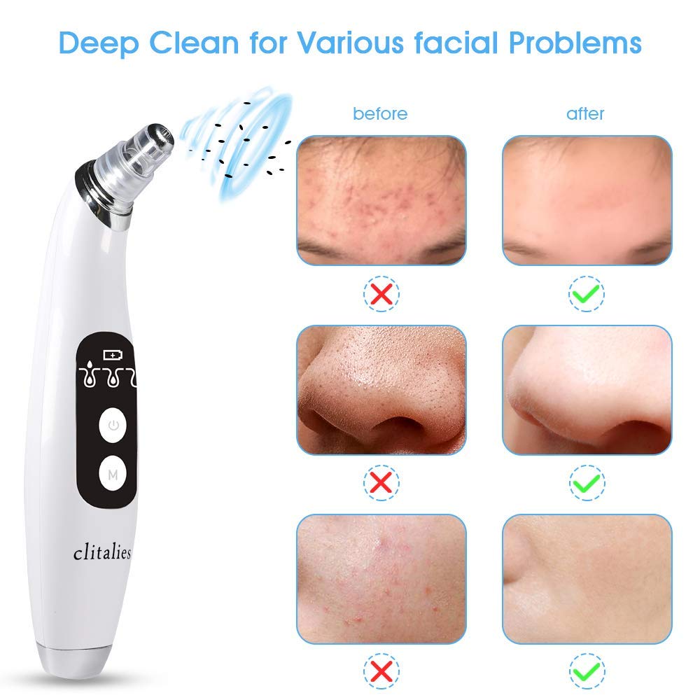 Blackhead Remover with Camera, Upgraded Pore Vacuum Cleaner, Visible Whitehead Remover Tool Pimple Blemish Acne Extractor Kit with 5 Replaceable Probes,20X Microscope,6 LED Lights - For Women Men Skin
