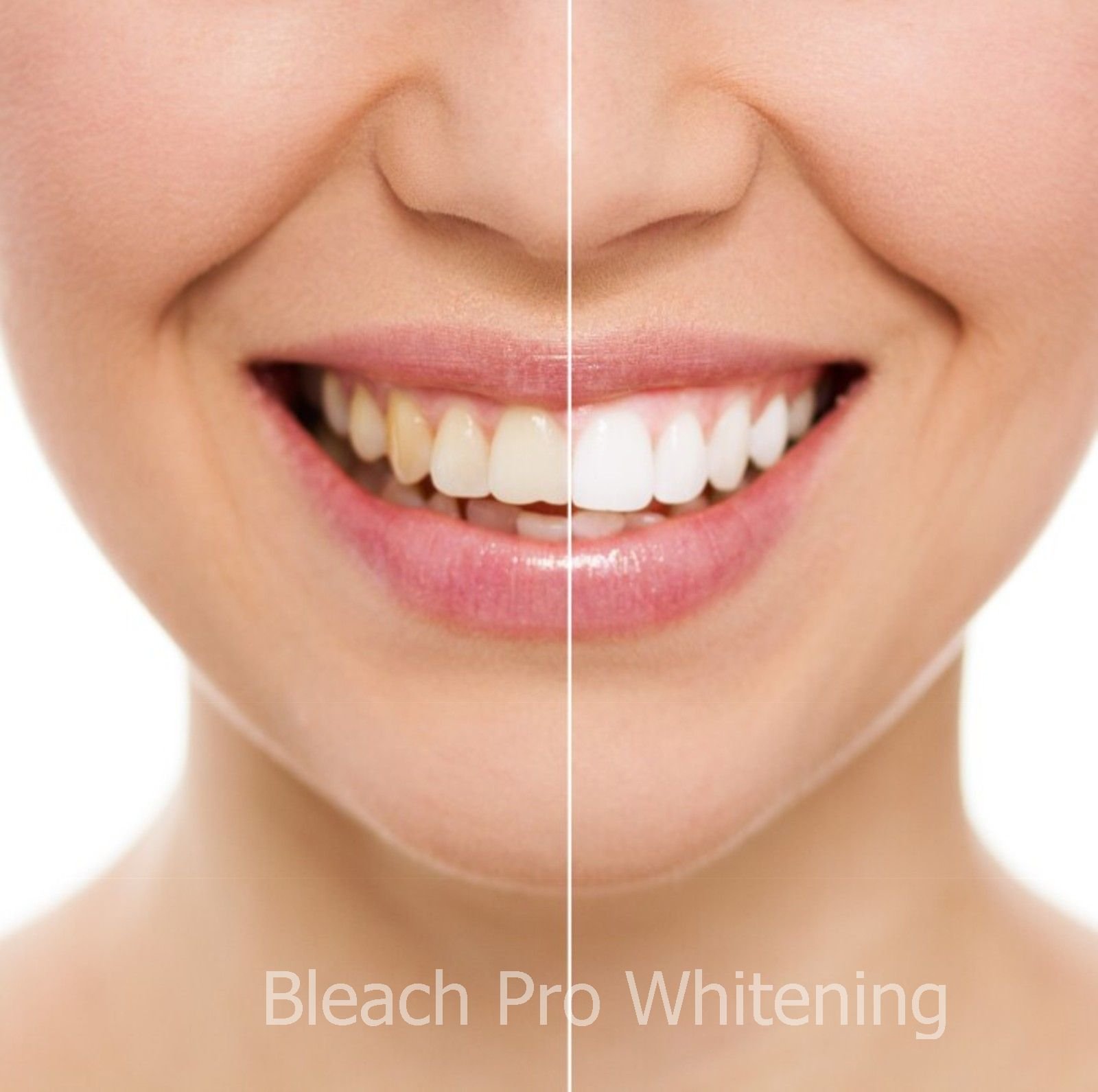 Teeth Whitening Gel Syringe Dispensers 22% Carbamide Peroxide, 10 Tooth Bleaching Gel 3ml Syringes
