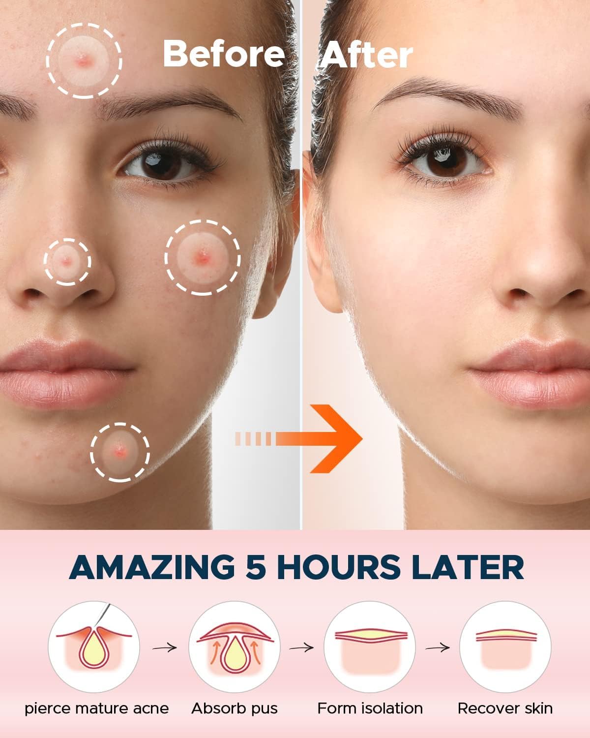 Pimple Patches with Extractor, Hydrocolloid Acne Patches for Face 4 Sizes 176 Count for Zit Breakouts, 2-in-1 Blackhead Remover & Pimple Popper Tool with Tea Tree & Calendula Oil