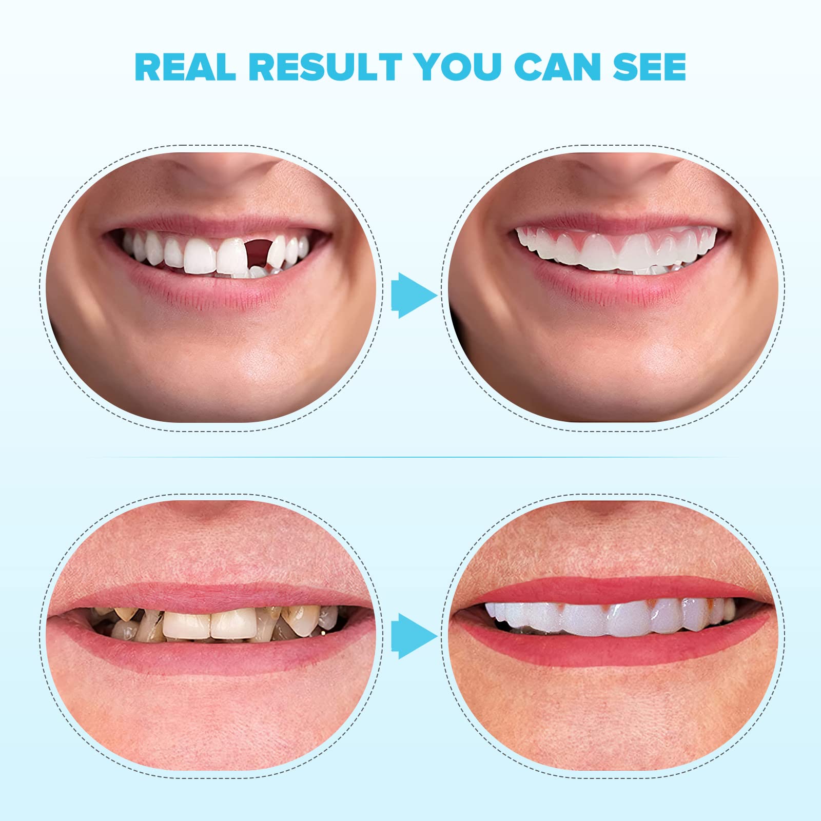 Fake Teeth, 6 PCS Dentures Teeth for Women and Men, Dental Veneers for Temporary Teeth Restoration, Nature and Comfortable, Protect Your Teeth and Regain Confident Smile, Natural Shade 6 PCS