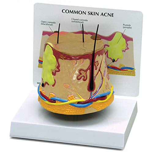 GPI Anatomicals - Skin Acne Model, Cylindrical Model Showing Normal and Common Acne-Riddled Skin for Human Anatomy and Physiology Education, Anatomy Model for Doctor's Office, Medical Study Supplies