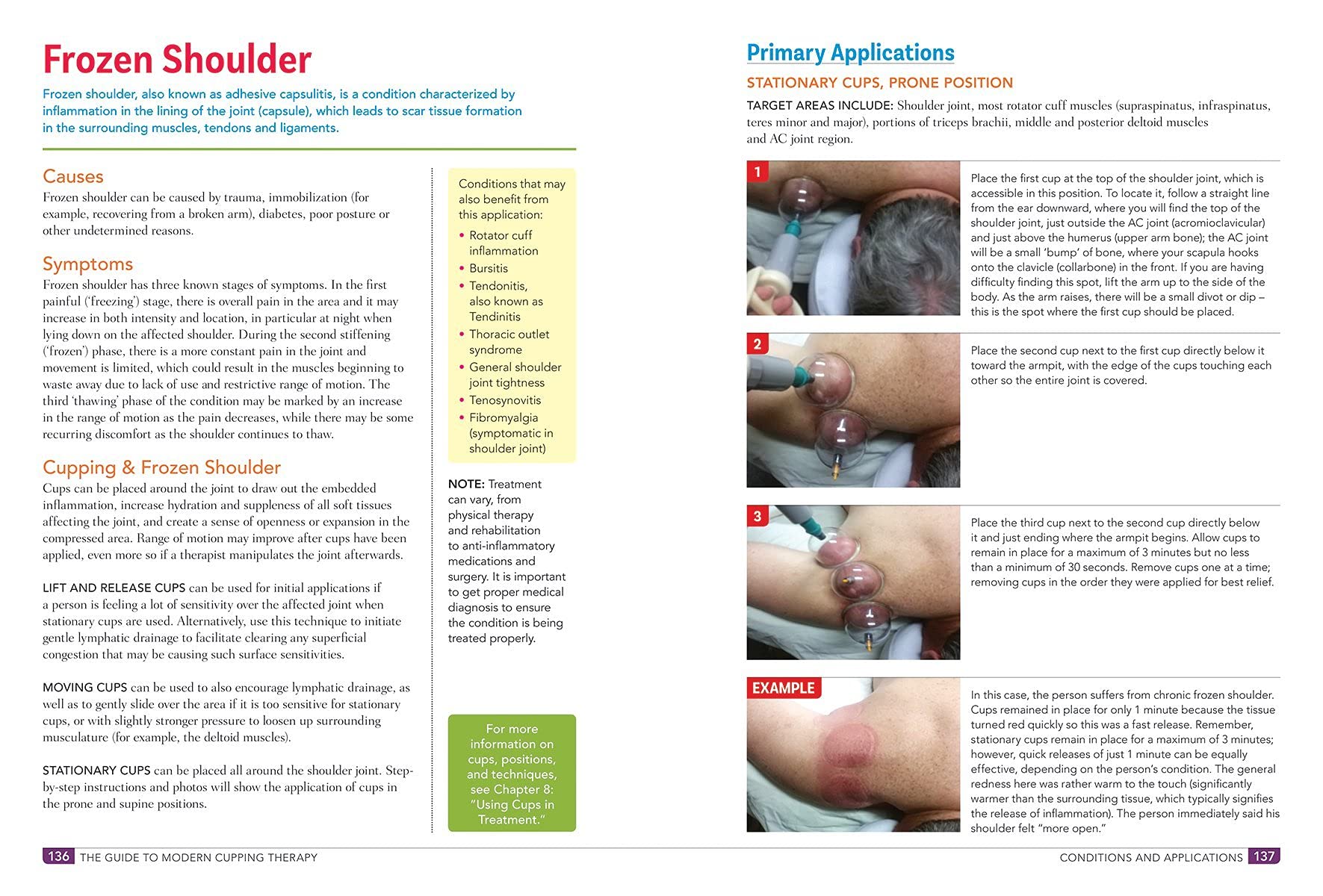 The Guide to Modern Cupping Therapy: Your Step-by-Step Source for Vacuum Therapy [Spiral-bound] Shannon Gilmartin